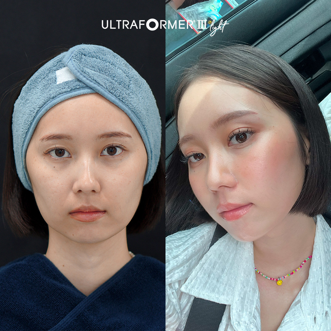 อยากหน้ากระชับ V Shape ทำ Ultraformer III ที่ Vdesign Clinic